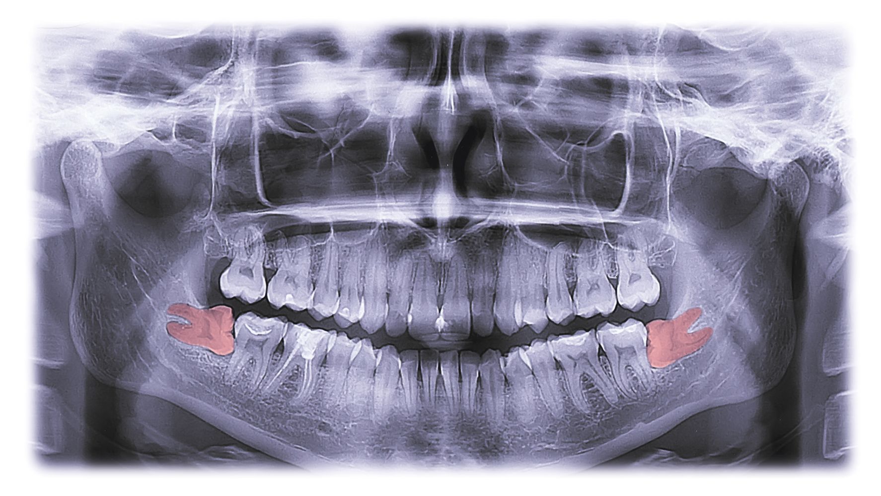 Sage Smiles: Does Everyone Have Wisdom Teeth? | Dr. Dhavalkumar Rana